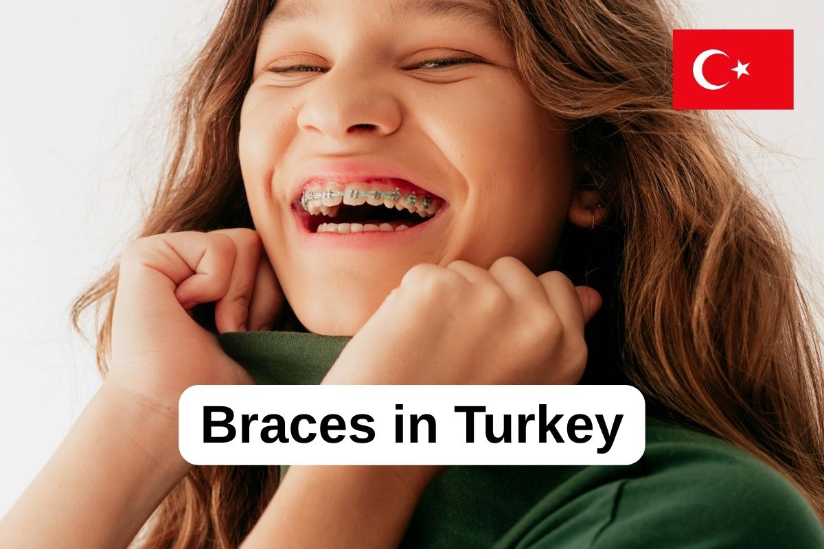 Braces in Turkey: Cost, Types, and Advantages - Denthub